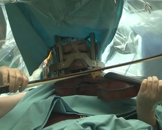 Brain surgery cures violinist's essential tremors | Article | The Strad